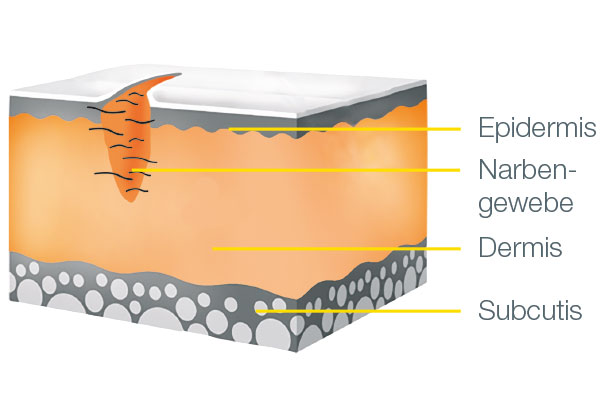 Narbenbildung. narbeninfo.de