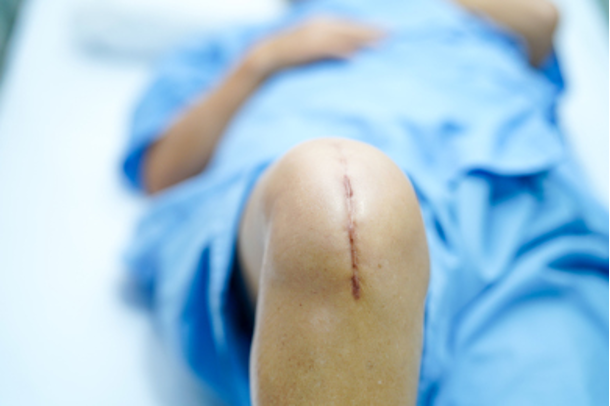 Knie-OP - Narbeninfo
